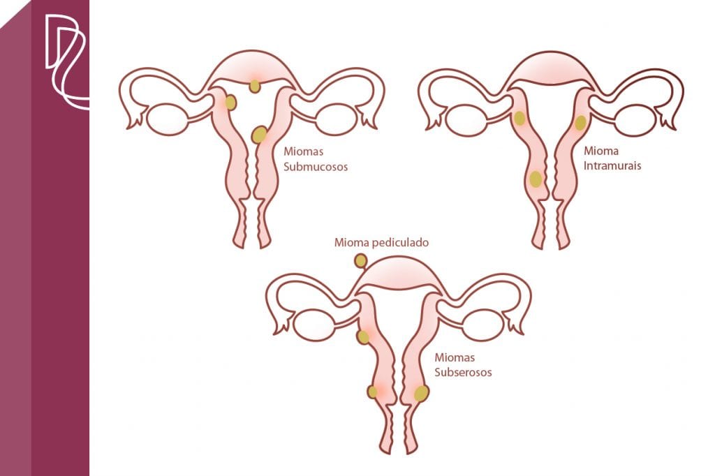 O Que é Mioma Parido - RETOEDU